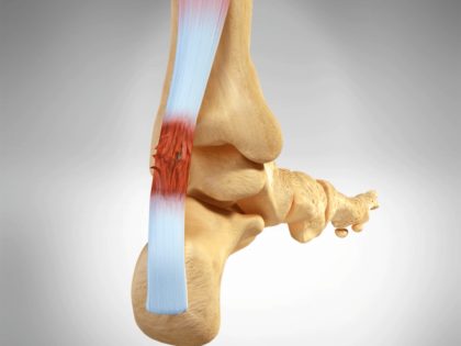 Cómo diferenciar la tendinosis de la tendinitis