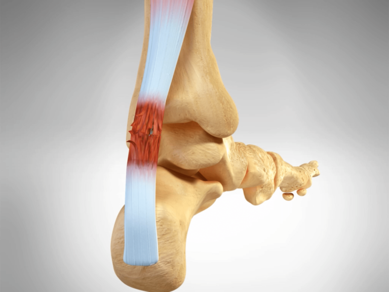 Cómo diferenciar la tendinosis de la tendinitis